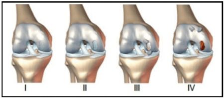 Fisioterapia en lesiones condrales de rodilla - Clínica Rehabilitación ...